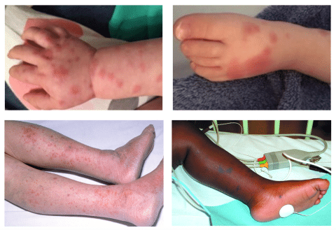 How to recognise sepsis in babies and children - Daisy First Aid