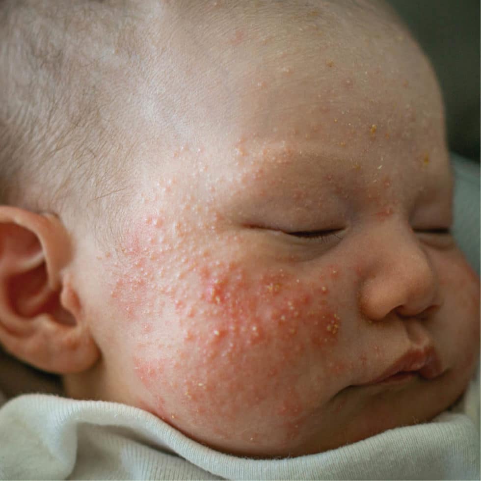 Baby Acne – causes and treatment - Daisy First Aid